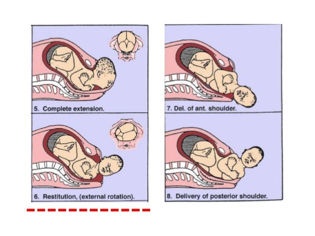 Shoulder Dystocia