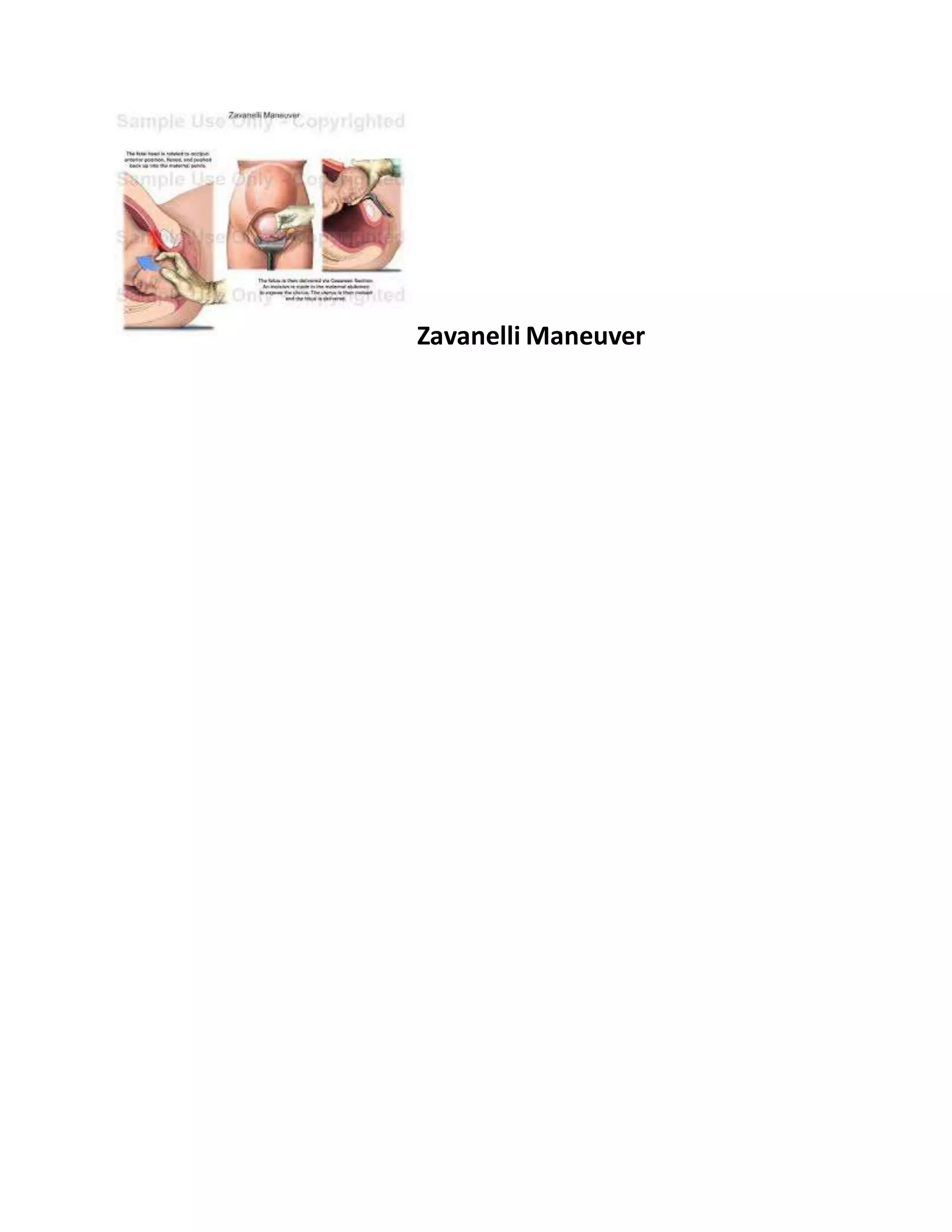 Shoulder dystocia | DOCX