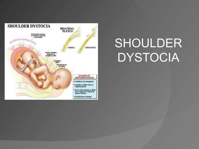 Shoulder dystocia | PPT