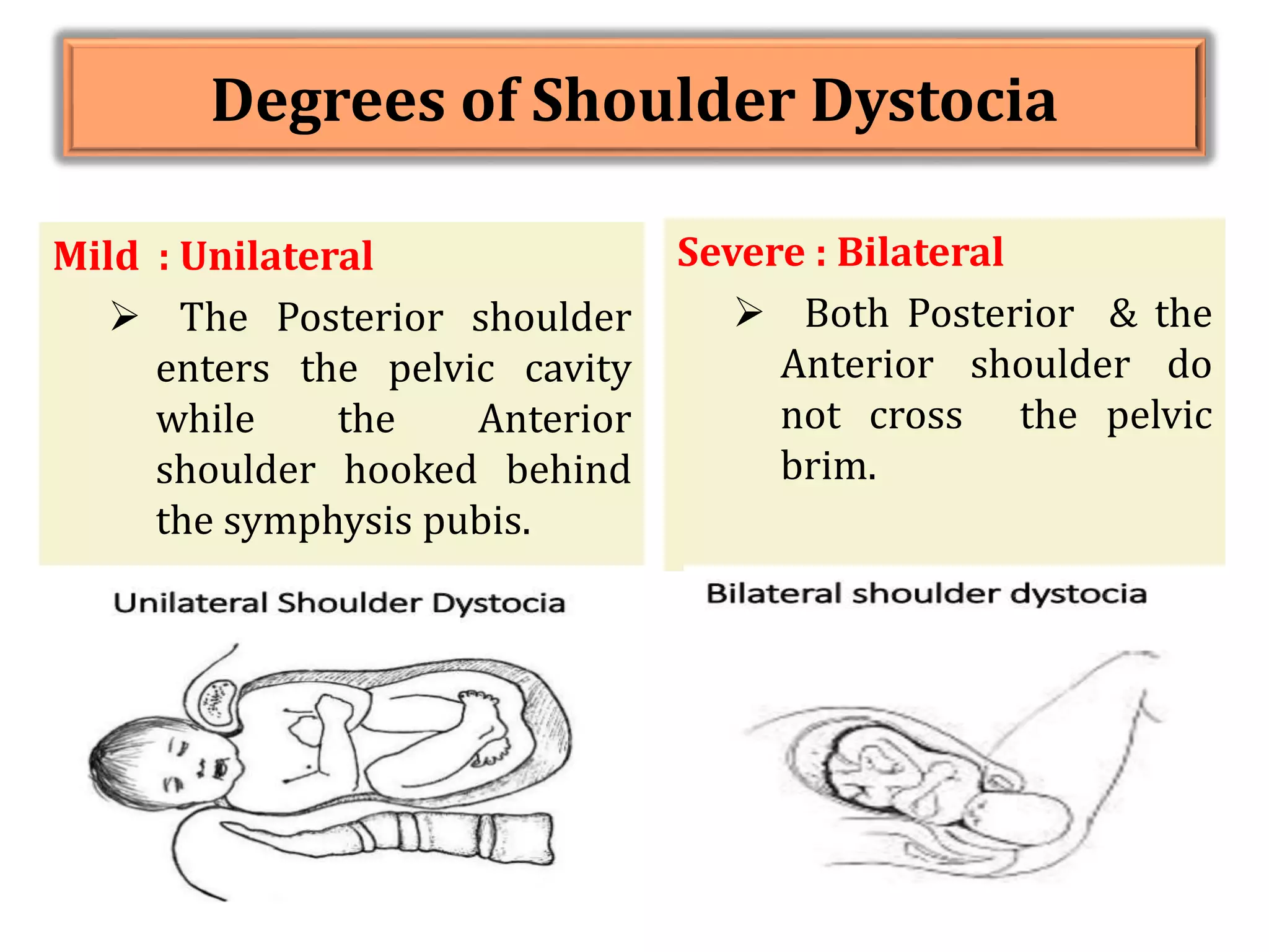 SHOULDER DYSTOCIA | PPTX