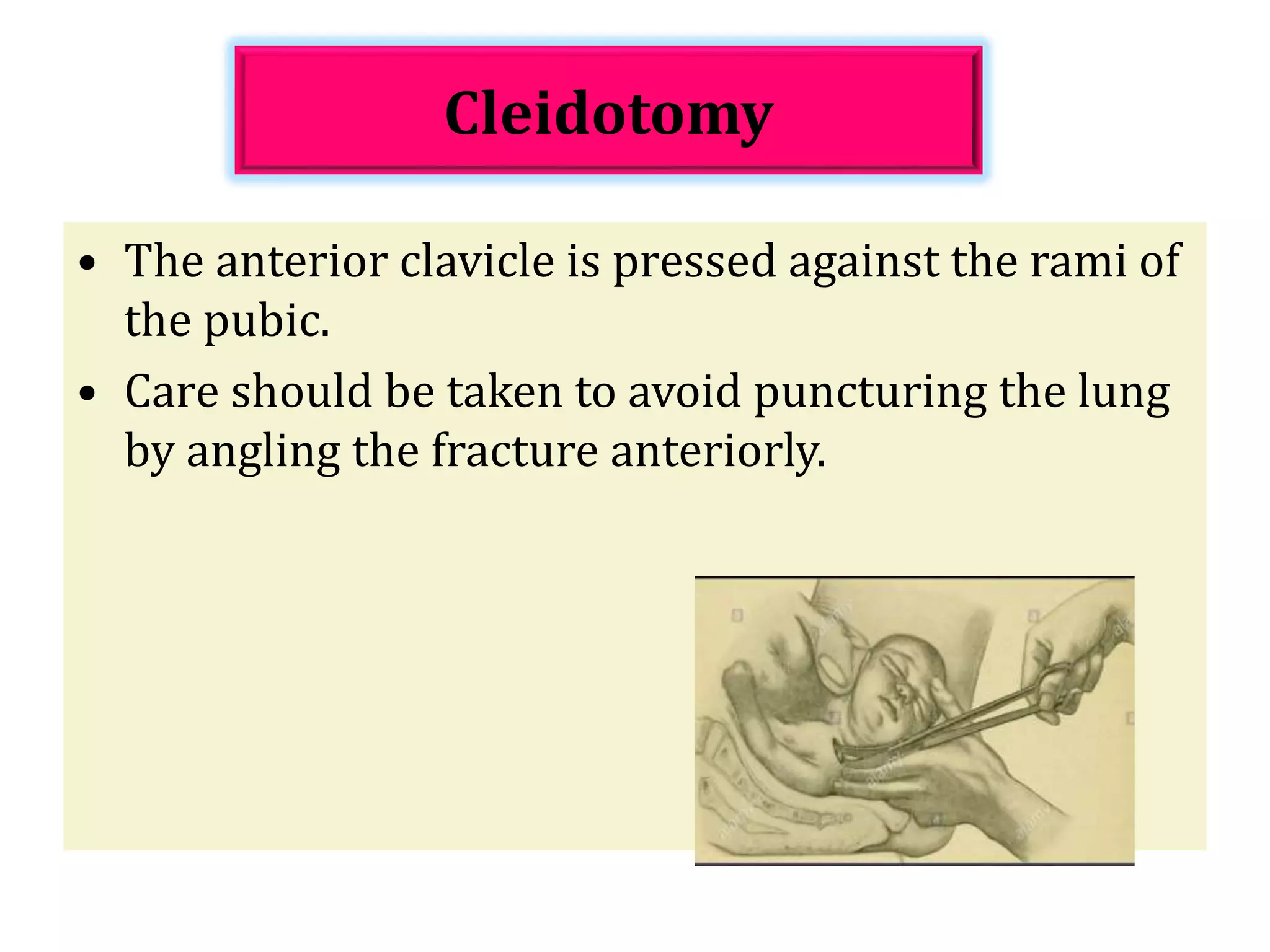 SHOULDER DYSTOCIA | PPTX