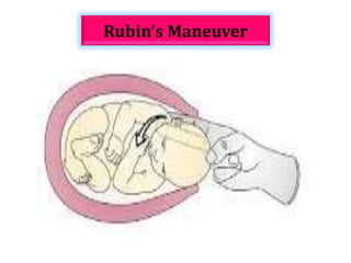 Rubin Maneuver