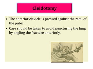 SHOULDER DYSTOCIA | PPT