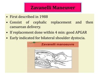 Zavanelli Maneuver