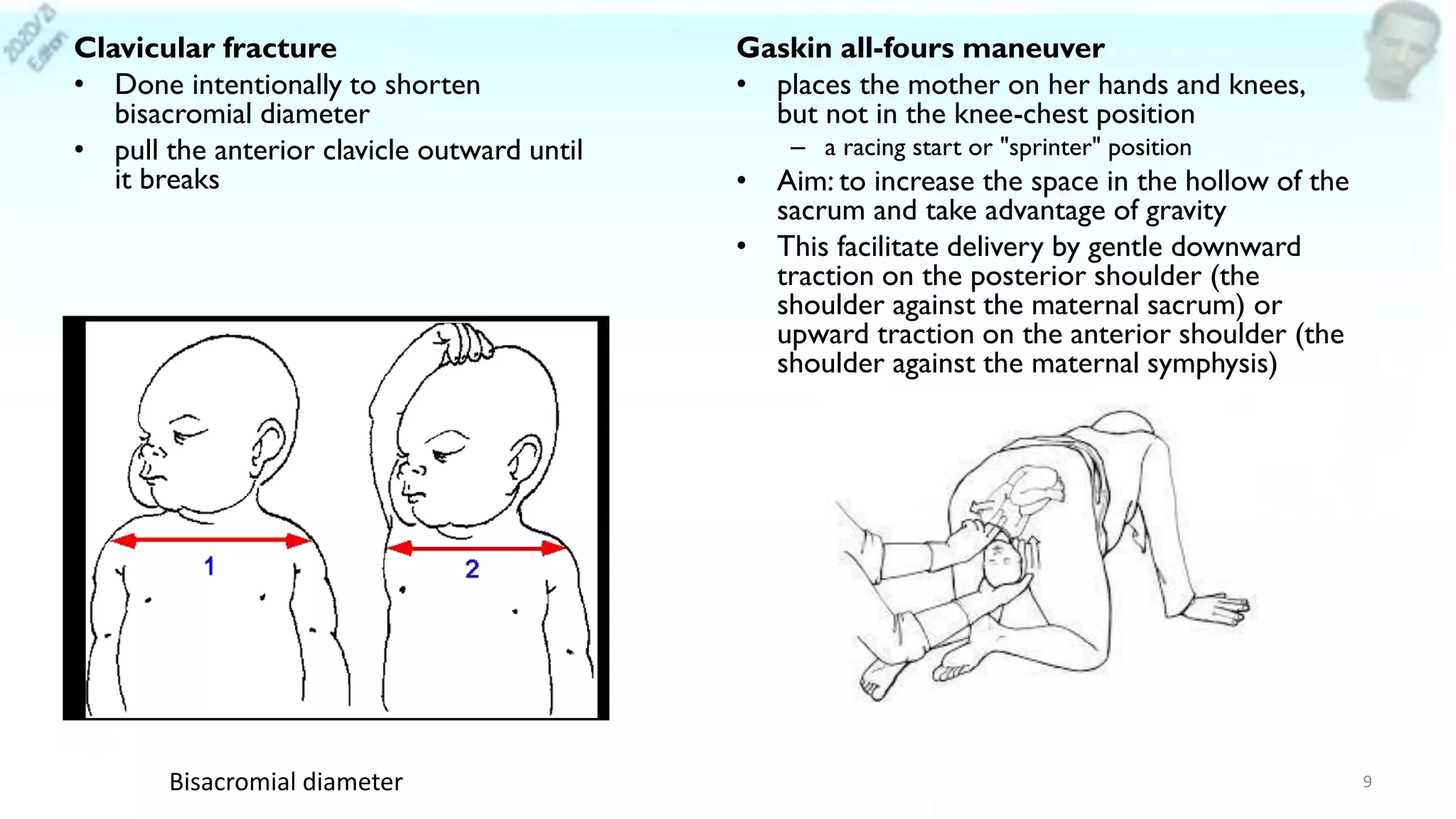 Shoulder dystocia 2021 | PDF