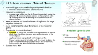 Shoulder dystocia 2021 | PDF