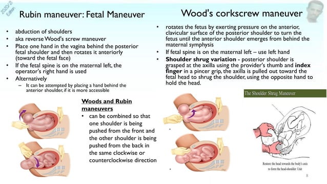 Shoulder dystocia 2021 | PDF