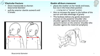 Shoulder dystocia 2021 | PDF