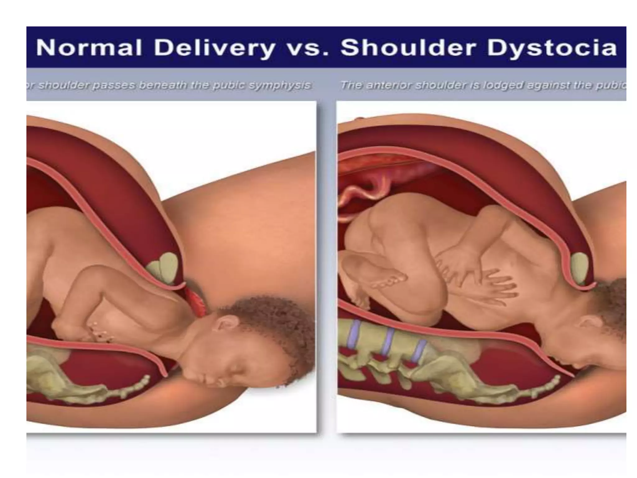 Shoulder dystocia.pptx