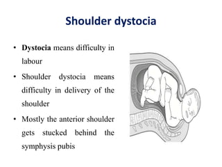 Shoulder dystocia.pptx
