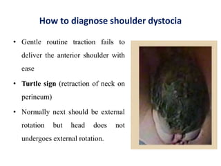 Shoulder dystocia.pptx