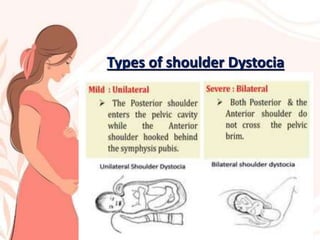 shoulder Dystocia.pptx