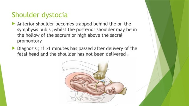 Shoulder_dystocia.pptx ( complications of delivery ,) | PPT