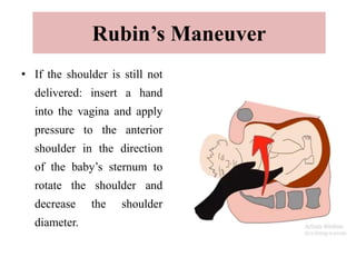 Shoulder dystocia 29.12.2020