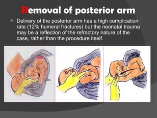 Shoulder dystocia ckk edit | PPT