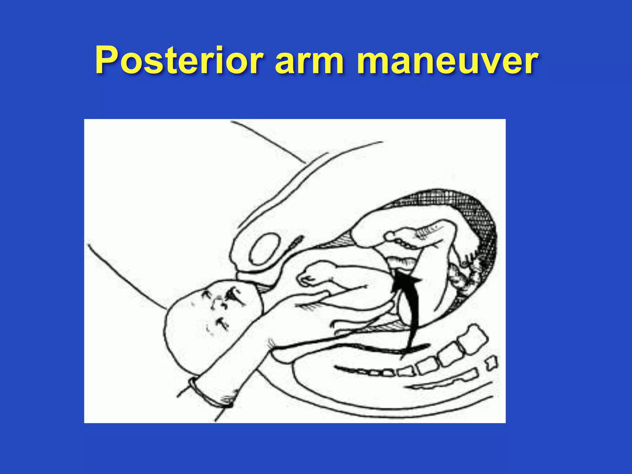 Shoulder dystocia (english) | PPT