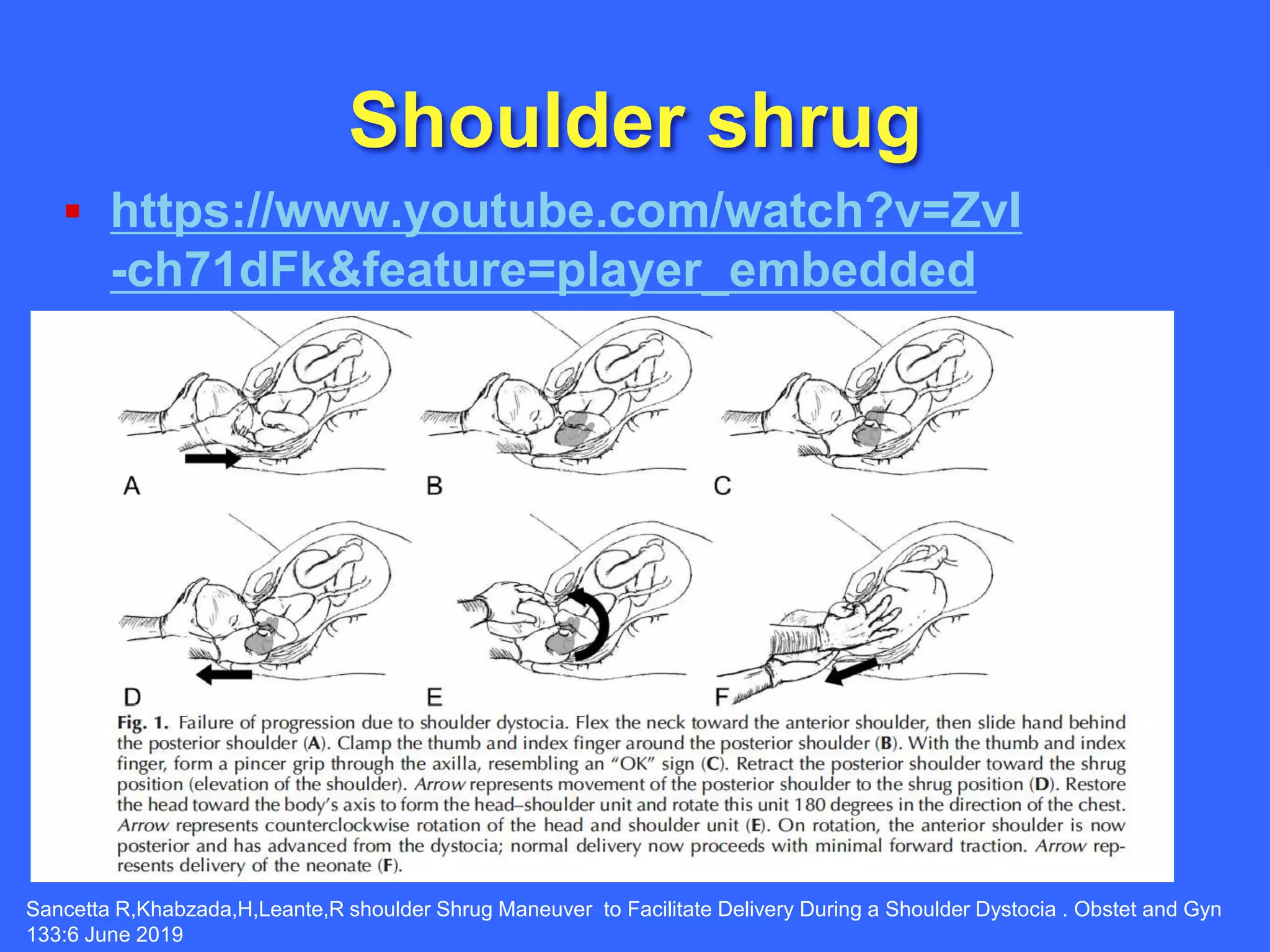Shoulder dystocia (english) | PPT