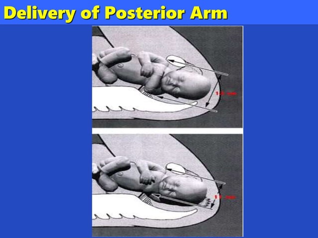Shoulder dystocia (english) | PPT