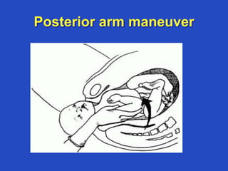 Shoulder dystocia (english) | PPT
