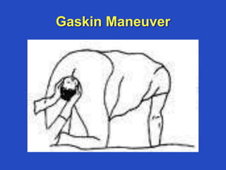 Gaskin Maneuver