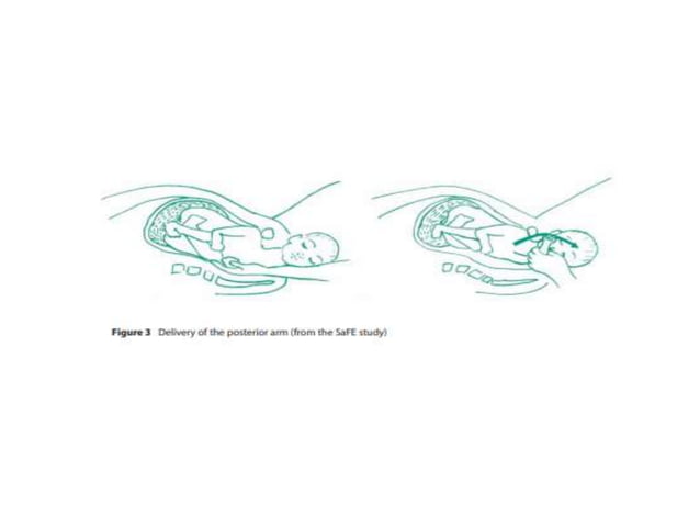 Shoulder dystocia management | PPTX | Pregnancy | Reproductive Health