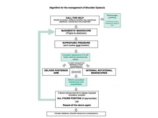 Shoulder dystocia management | PPTX