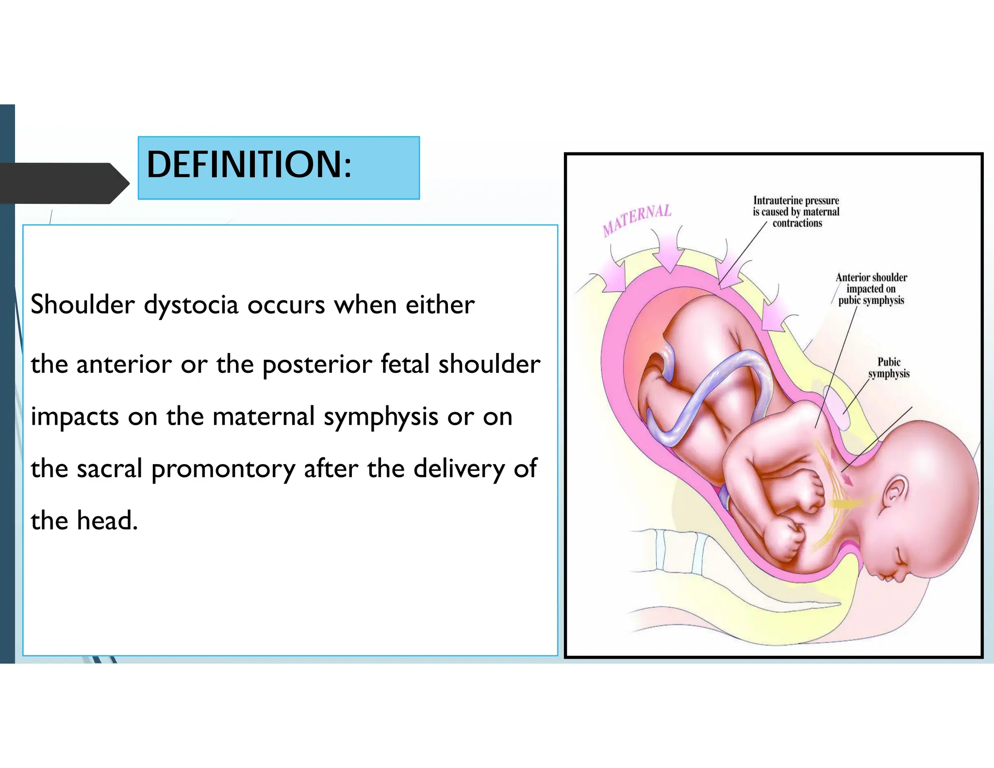 Presentation on shoulder dystocia Powerpoint | PDF