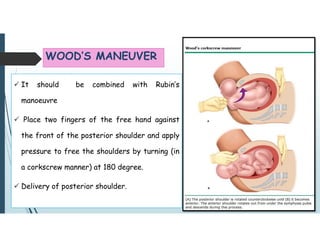 Presentation on shoulder dystocia Powerpoint | PDF