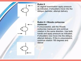 Shoulder dystocia rabi | PPT