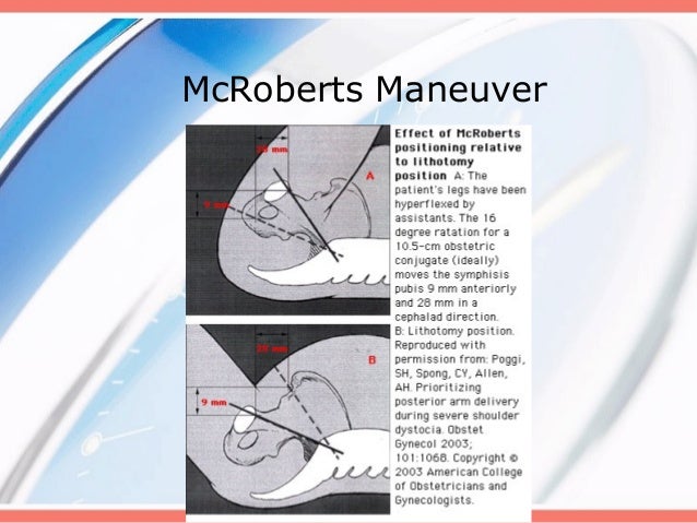 Shoulder dystocia rabi