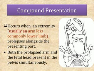 Compound Presentation Maternity