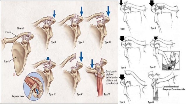Shoulder fx & dislocation