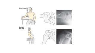 Fracture around Shoulder Girdle Dr.Kushal | PPTX