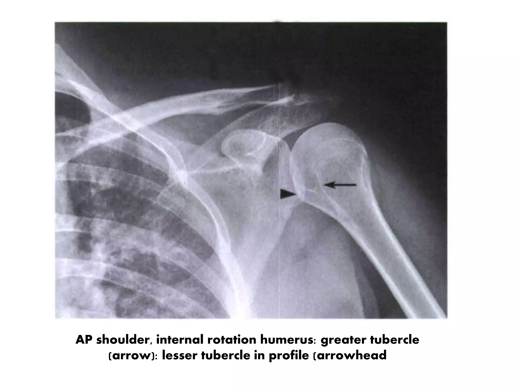 Shoulder girdle presentation | PPTX