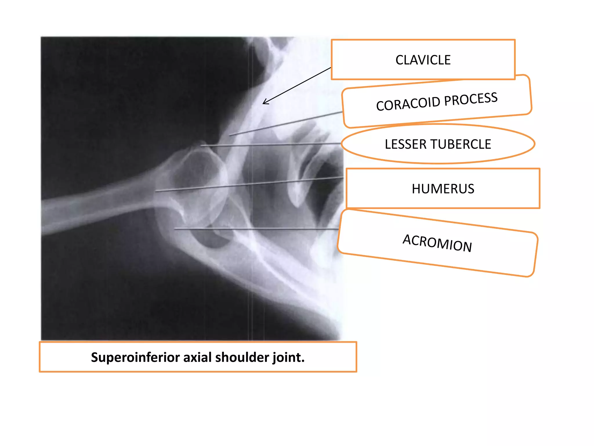 Shoulder girdle presentation | PPTX
