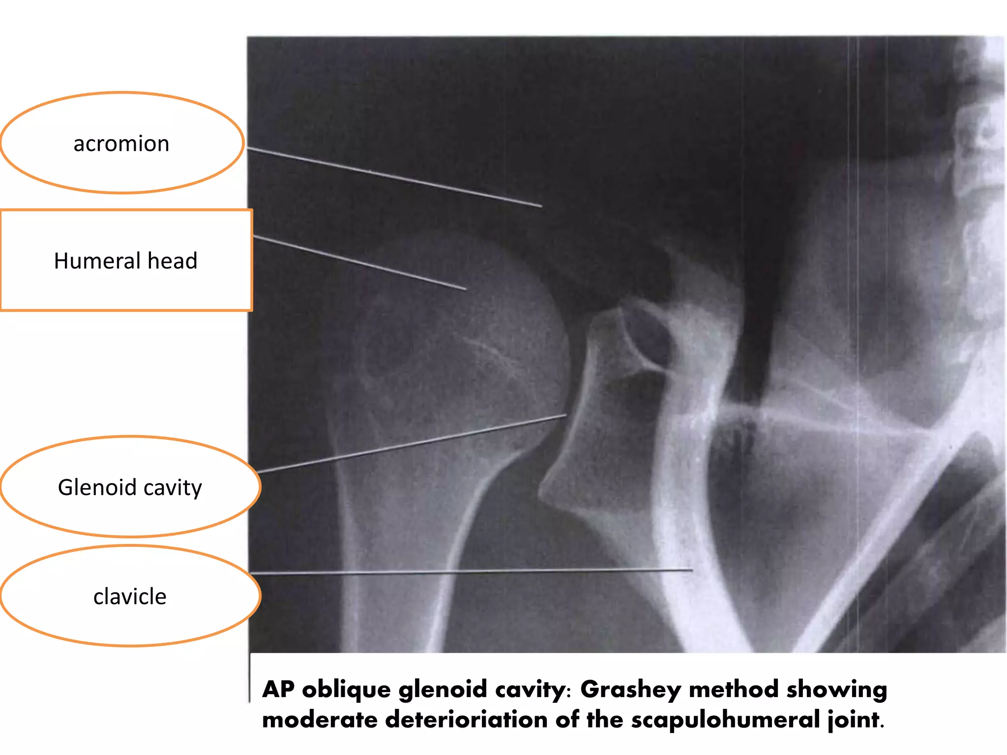 Shoulder girdle presentation | PPTX