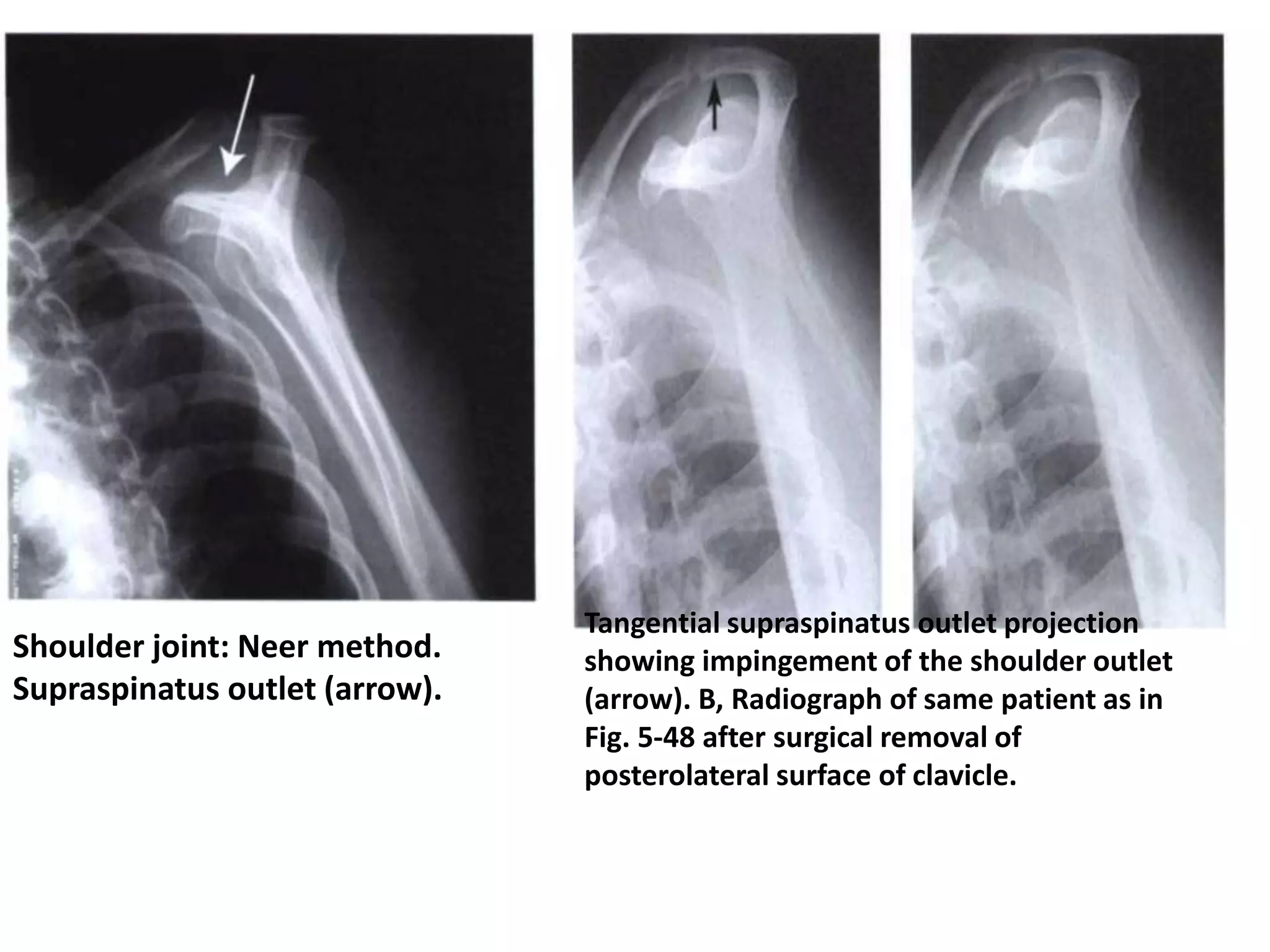 Shoulder girdle presentation | PPTX
