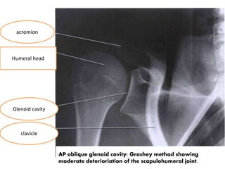 Shoulder girdle presentation | PPTX