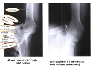 Shoulder girdle presentation | PPTX