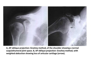 Shoulder girdle presentation | PPTX