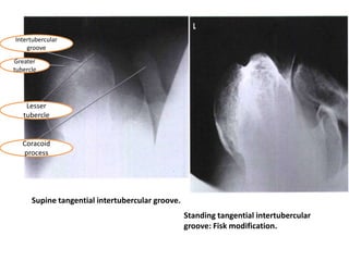 Intertubercular Groove Xray