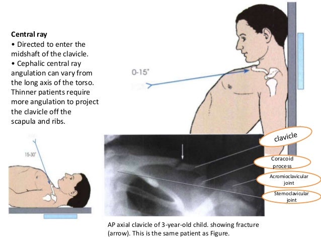 Shoulder girdle presentation