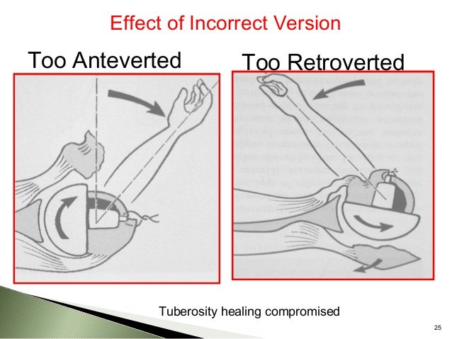 Shoulder Arthroplasty for Fractures.