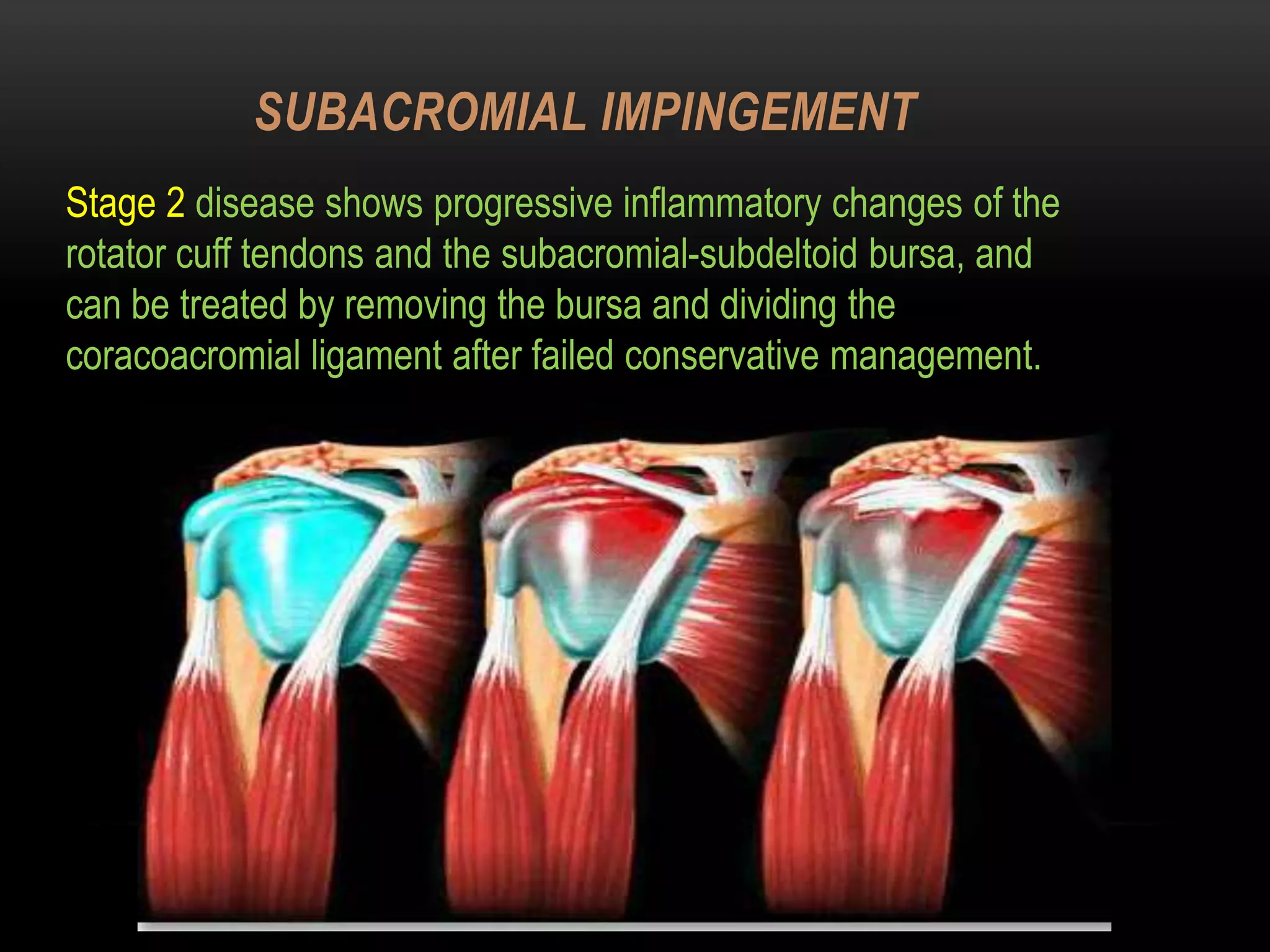 Shoulder impingement | PPTX