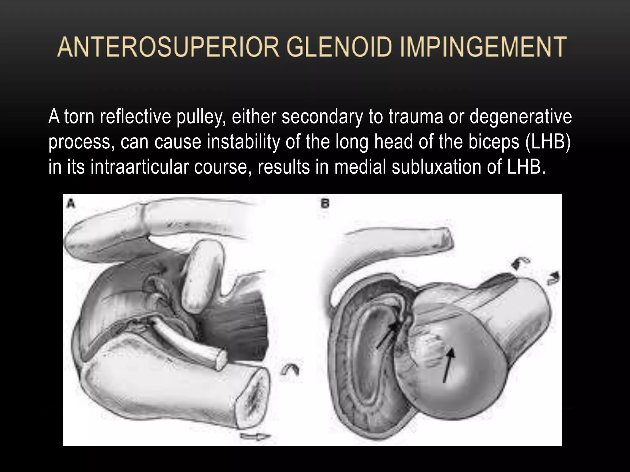 Shoulder impingement | PPTX