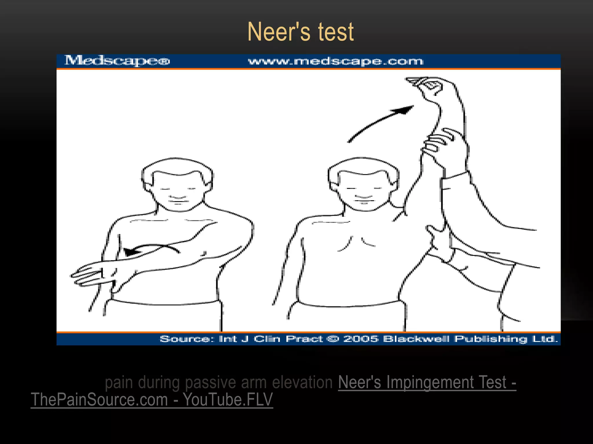 Shoulder impingement | PPTX