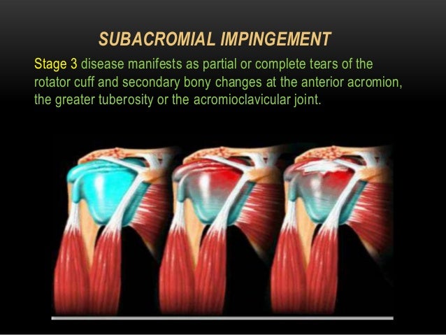 Shoulder impingement