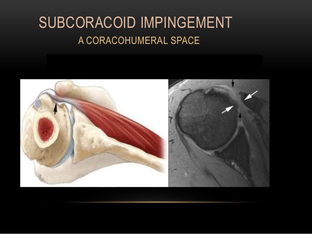 Subcoracoid Space