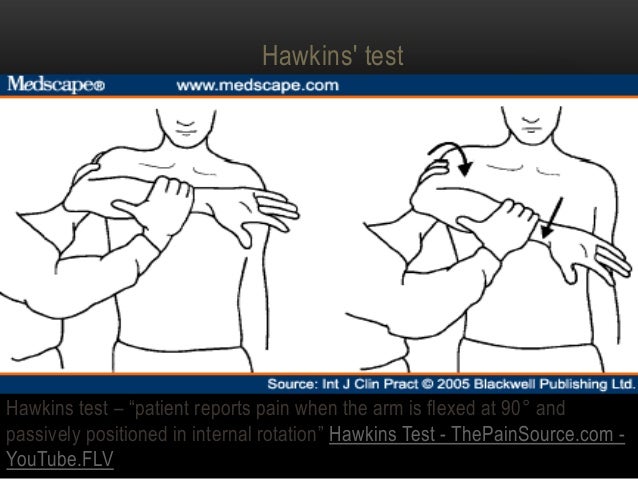 Shoulder impingement