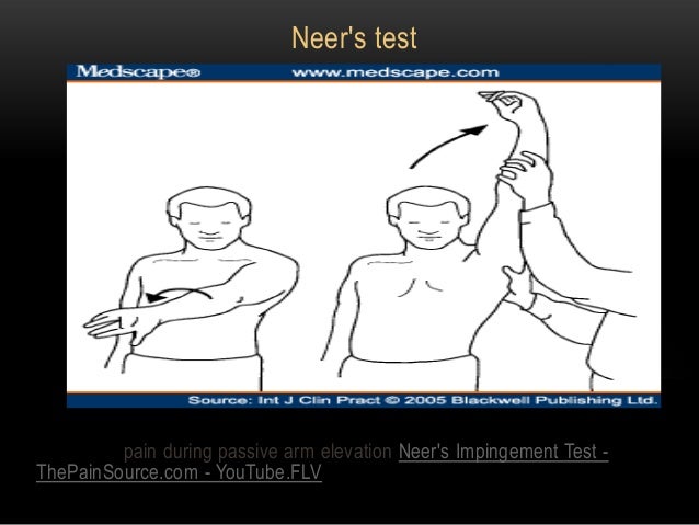 Shoulder impingement